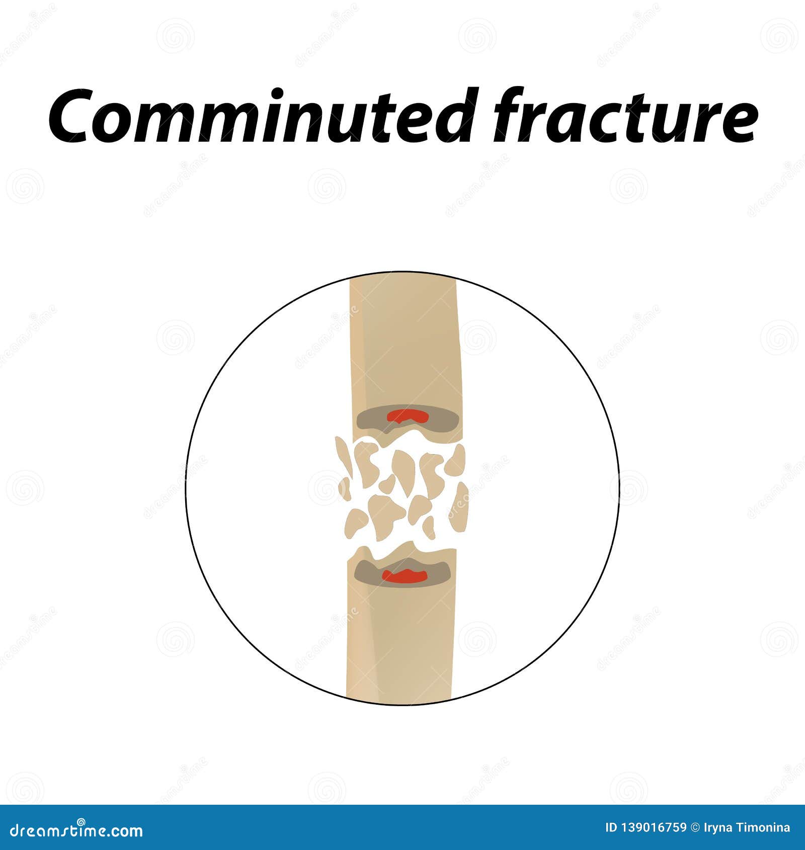 Comminuted Fracture Bone. Infographics. Vector Illustration on a Lined ...