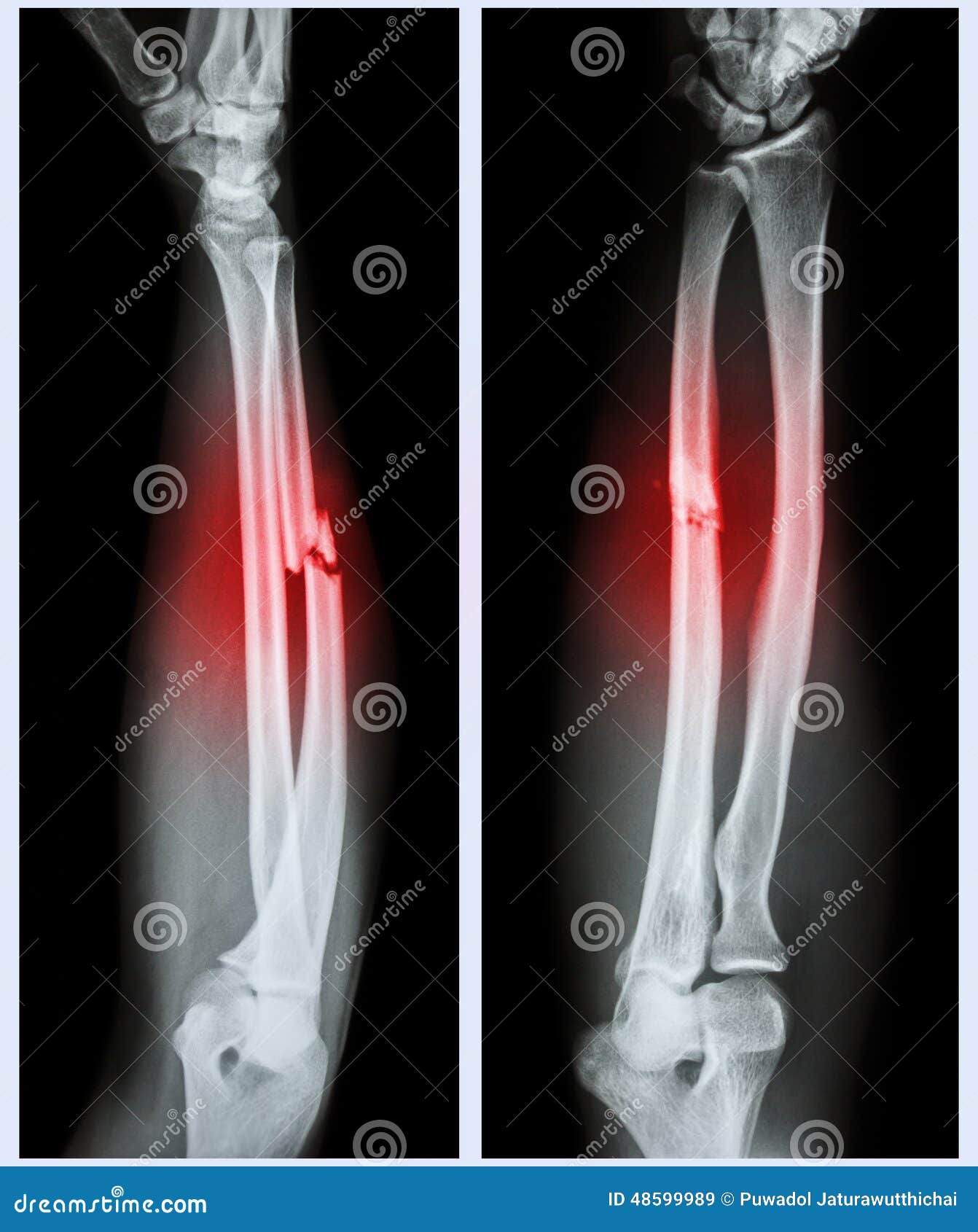Comminuted Fracture Shaft of Ulnar Bone Stock Image - Image of ...