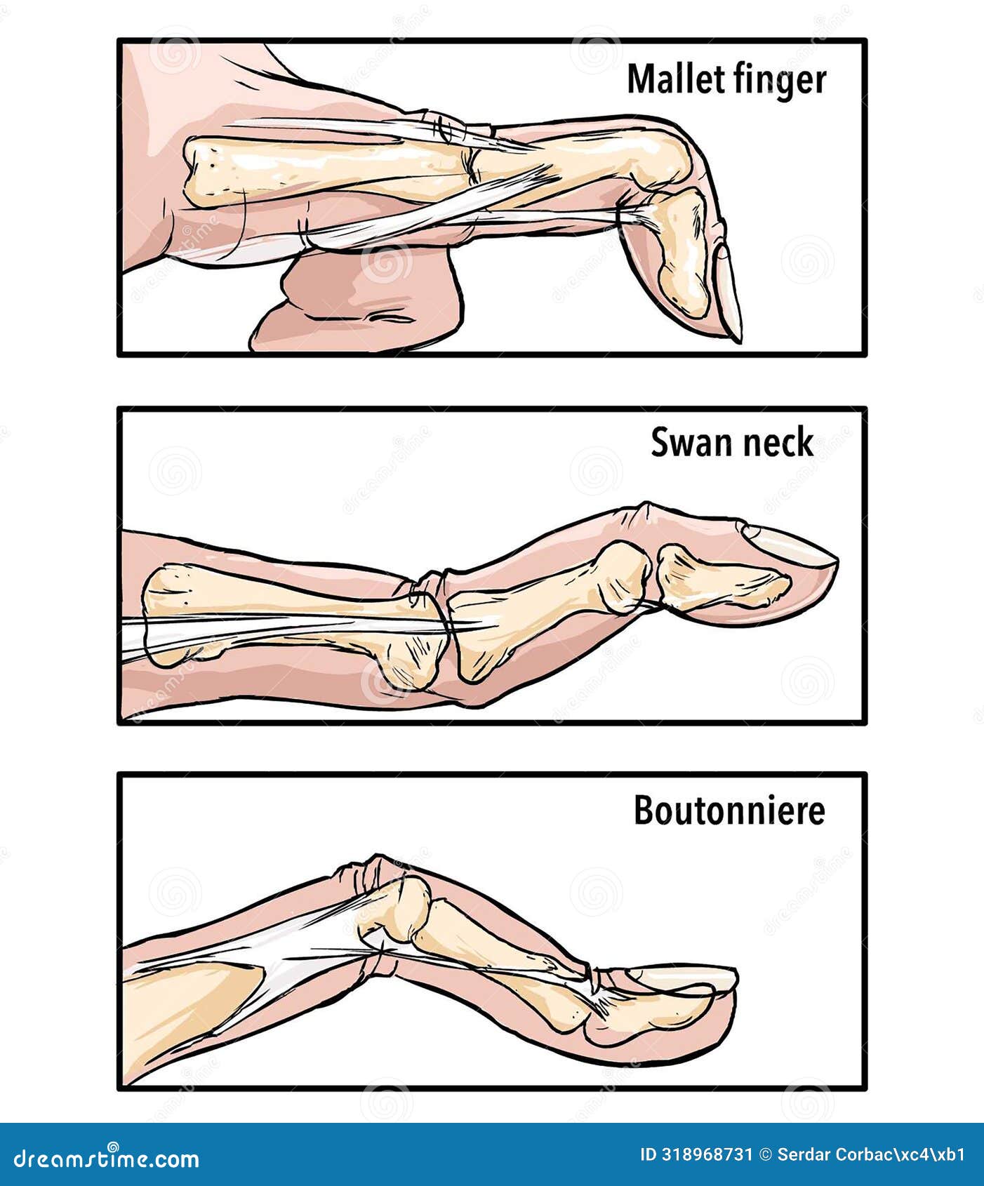 Common Finger Injuries Vector Illustration | CartoonDealer.com #318968731