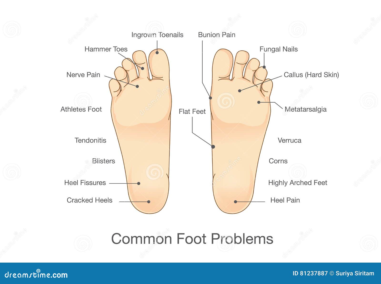 Common foot problems. stock vector. Illustration of heels - 81237887