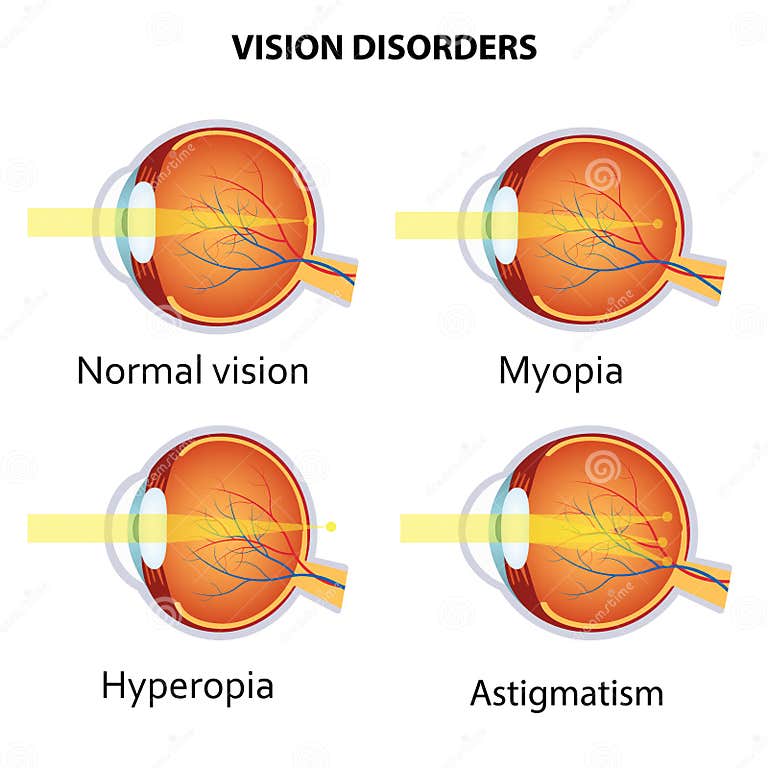 Common vision disorders. stock vector. Illustration of disorder - 78029425