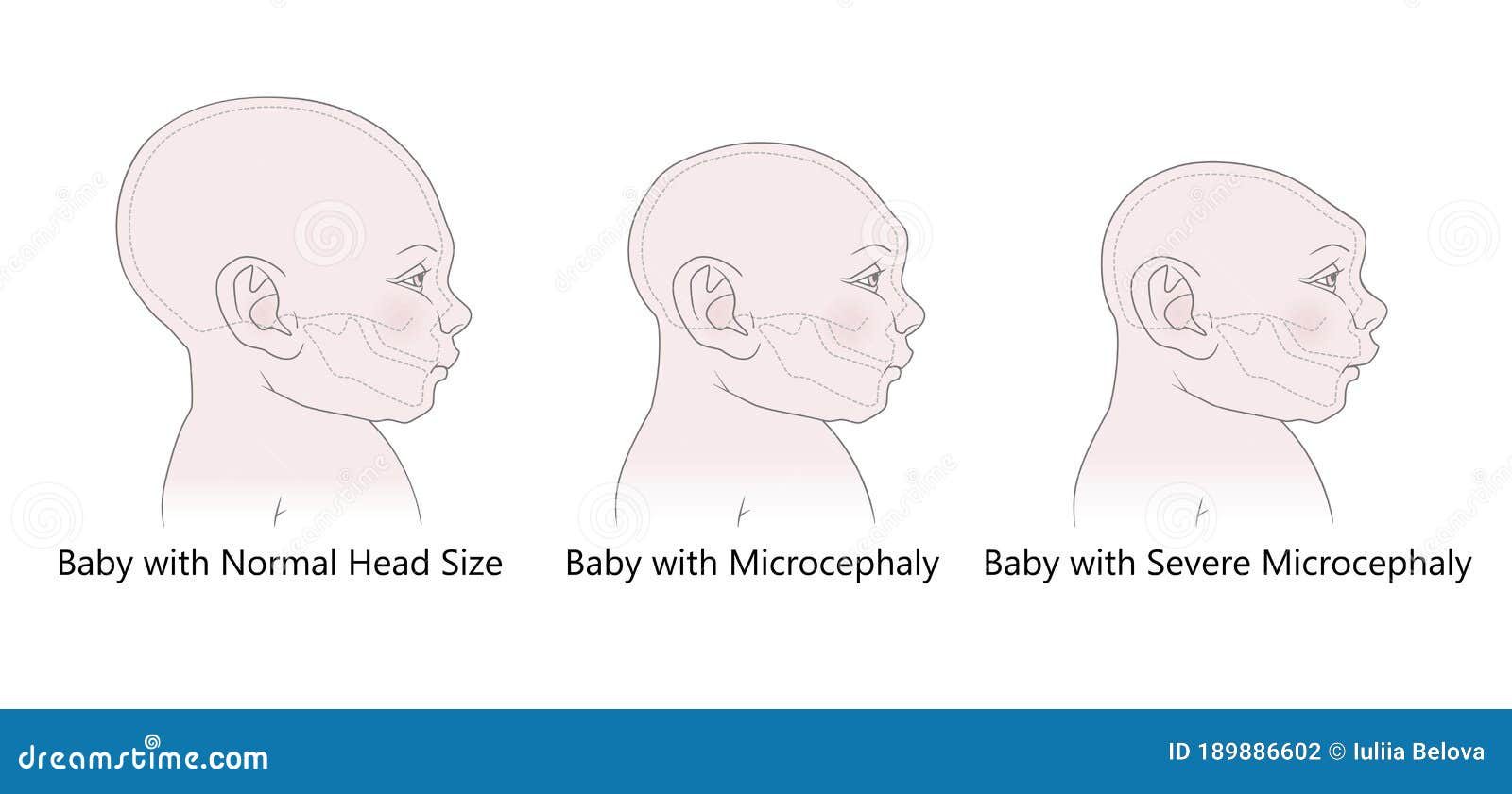 Comparative Anatomical Image Of The Head And Skull Of A Newborn Child ...