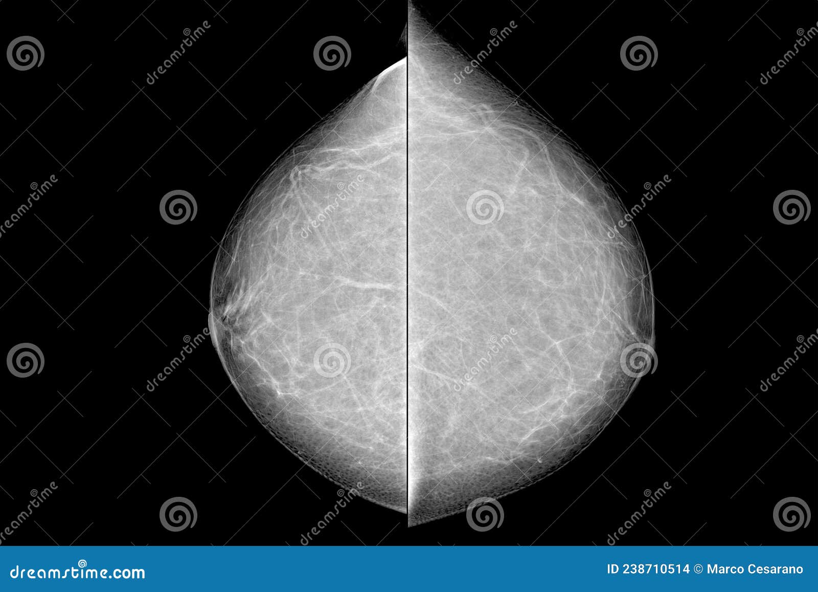 Comparative Mammogram in Caudal-skull Projection Stock Photo - Image of ...