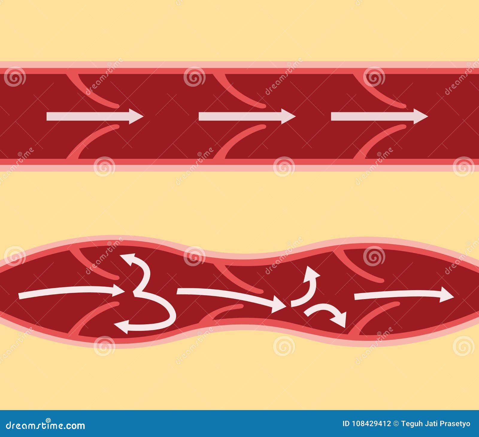 Normal Vein And Varicose Vein Cartoon Vector | CartoonDealer.com #43186125
