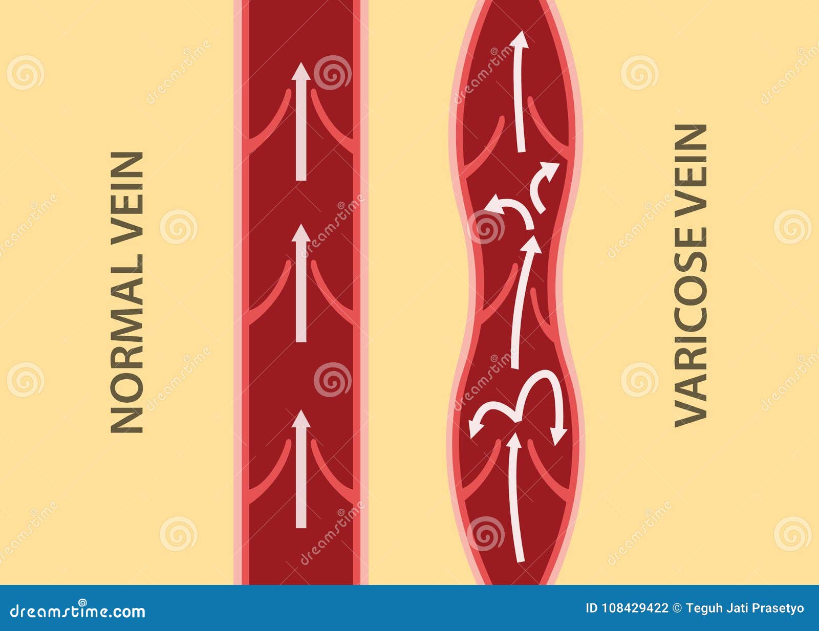 Compare Between Normal Blood Cell Vs Anemia Disease Sick Cartoon Vector ...