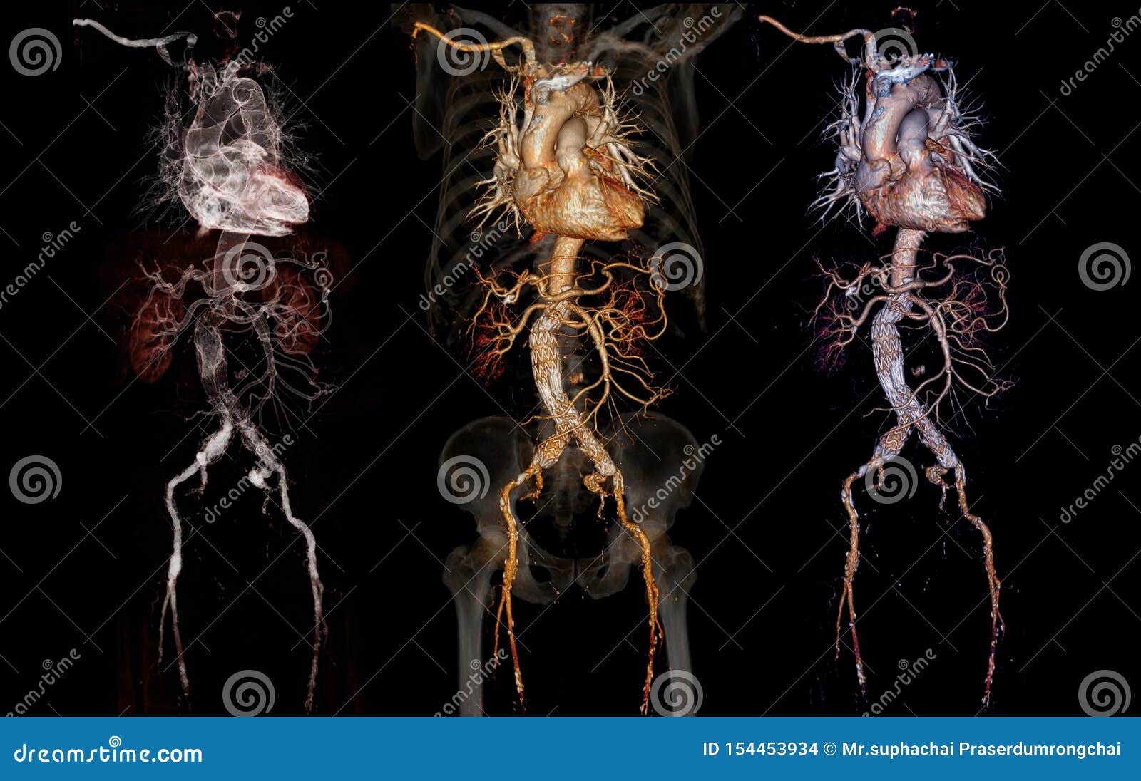 Comparison of CTA Abdominal Aorta 3D Rendering Image Stock Illustration ...