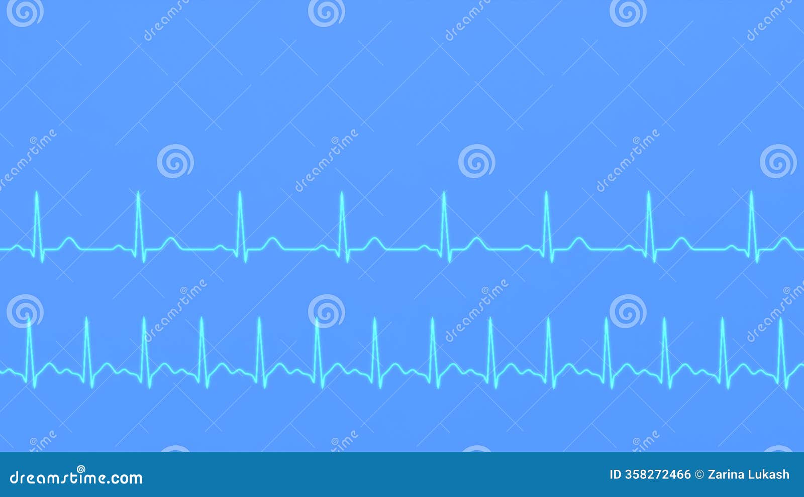 Comparison of ECG of Normal Heart Rhythm and Tachycardia. Stock Photo ...