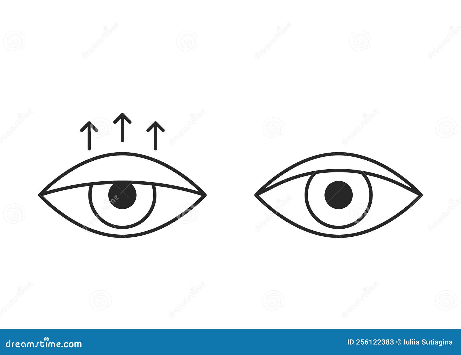 Lid Ptosis Stock Illustrations 28 Lid Ptosis Stock Illustrations