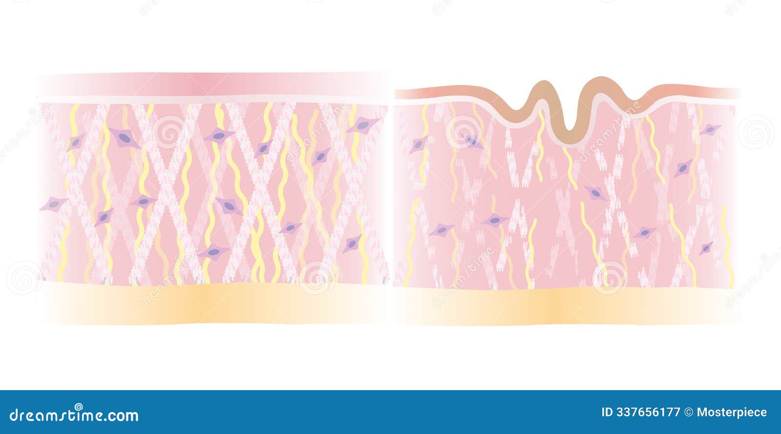 Intact Collagen, Elastin Fibers And Fibroblasts With Skin Layer Vector ...