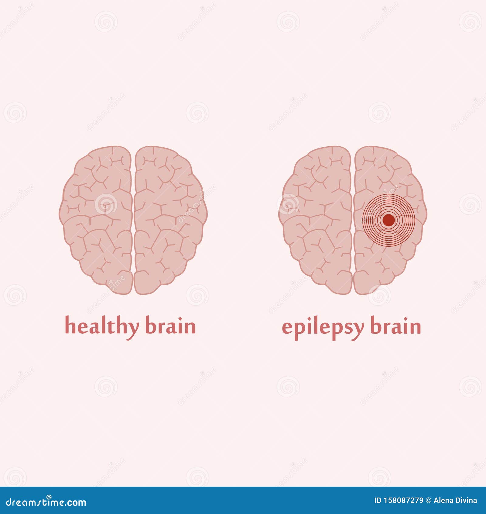 Epilepsy brain stock vector. Illustration of examination - 158087279 Epilepsy brain stock vector. Illustration of examination - 158087279