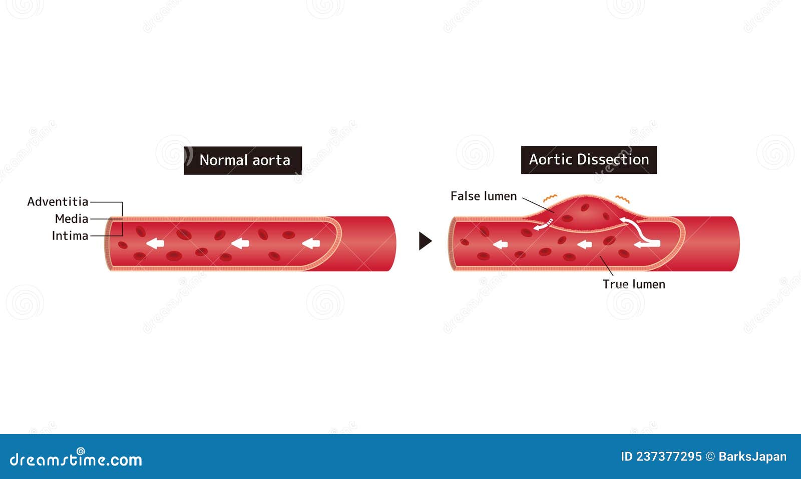Comparison Illustration of Normal Aorta and Aortic Dissection Stock ...