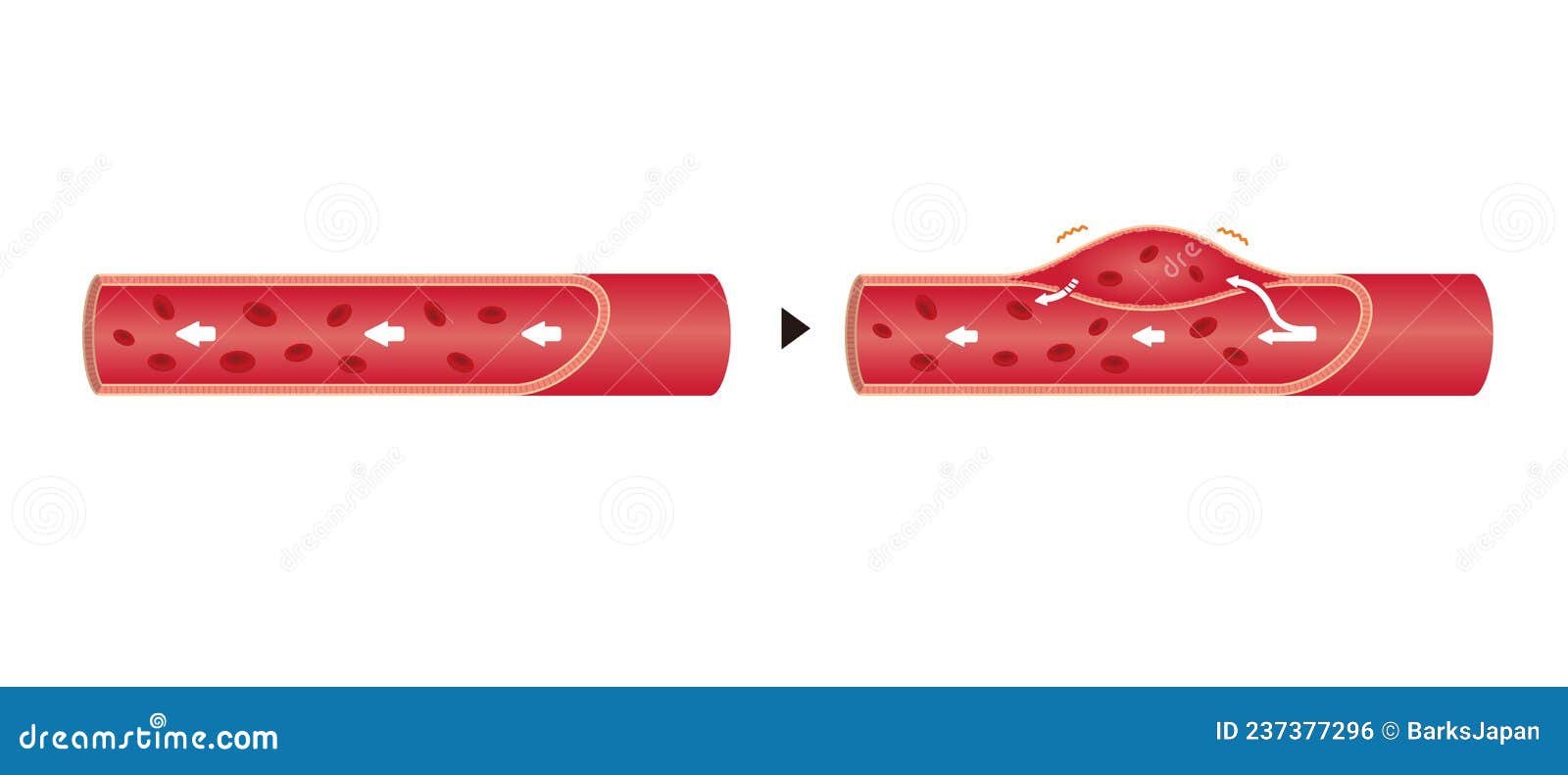 Aortic Dissection. Longitudinal And Cross-section Of Blood Vessel ...