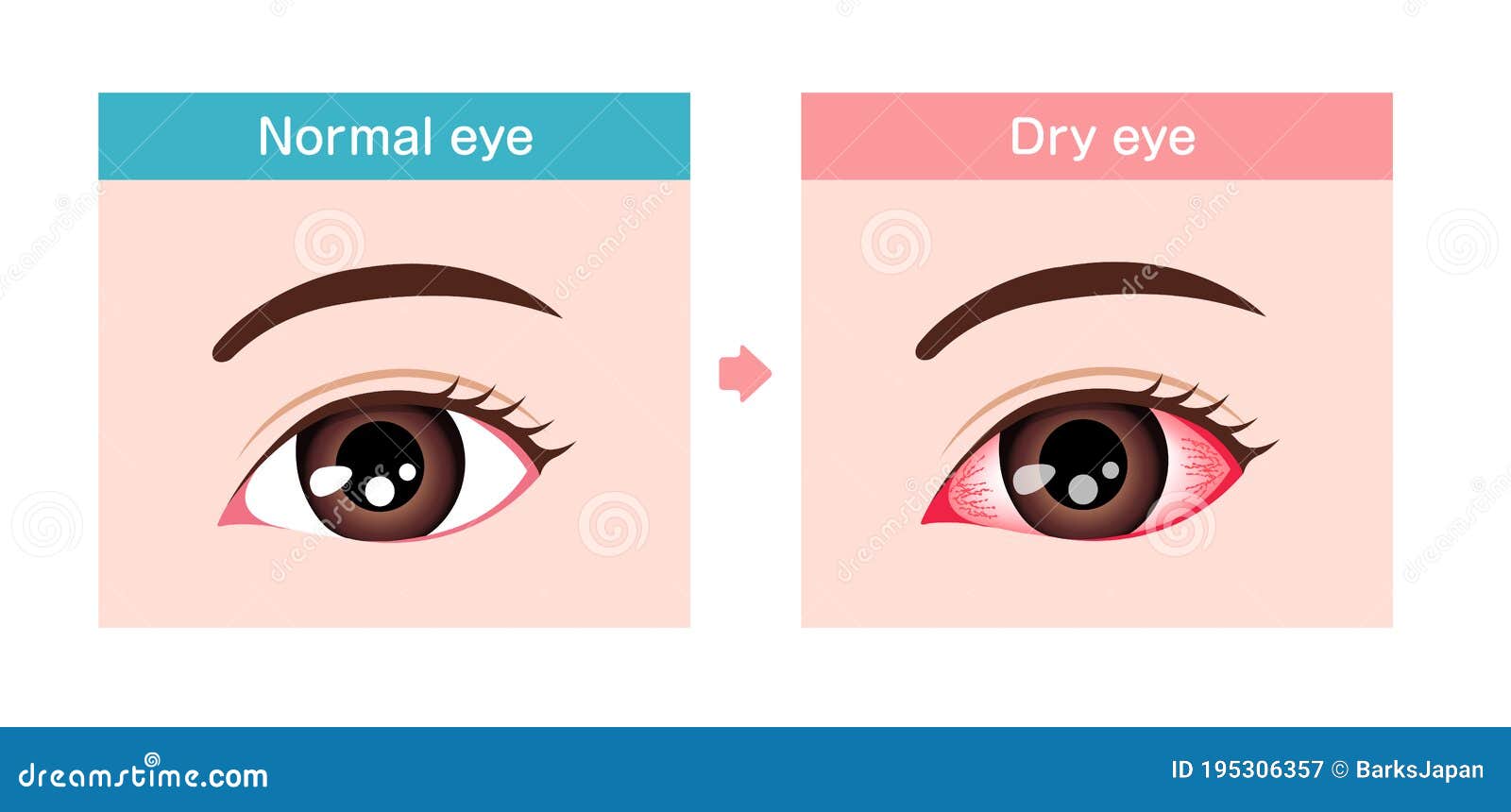 Normal Eye And Conjunctivitis Pink Eye Vector Illustration ... Normal Eye And Conjunctivitis Pink Eye Vector Illustration ...