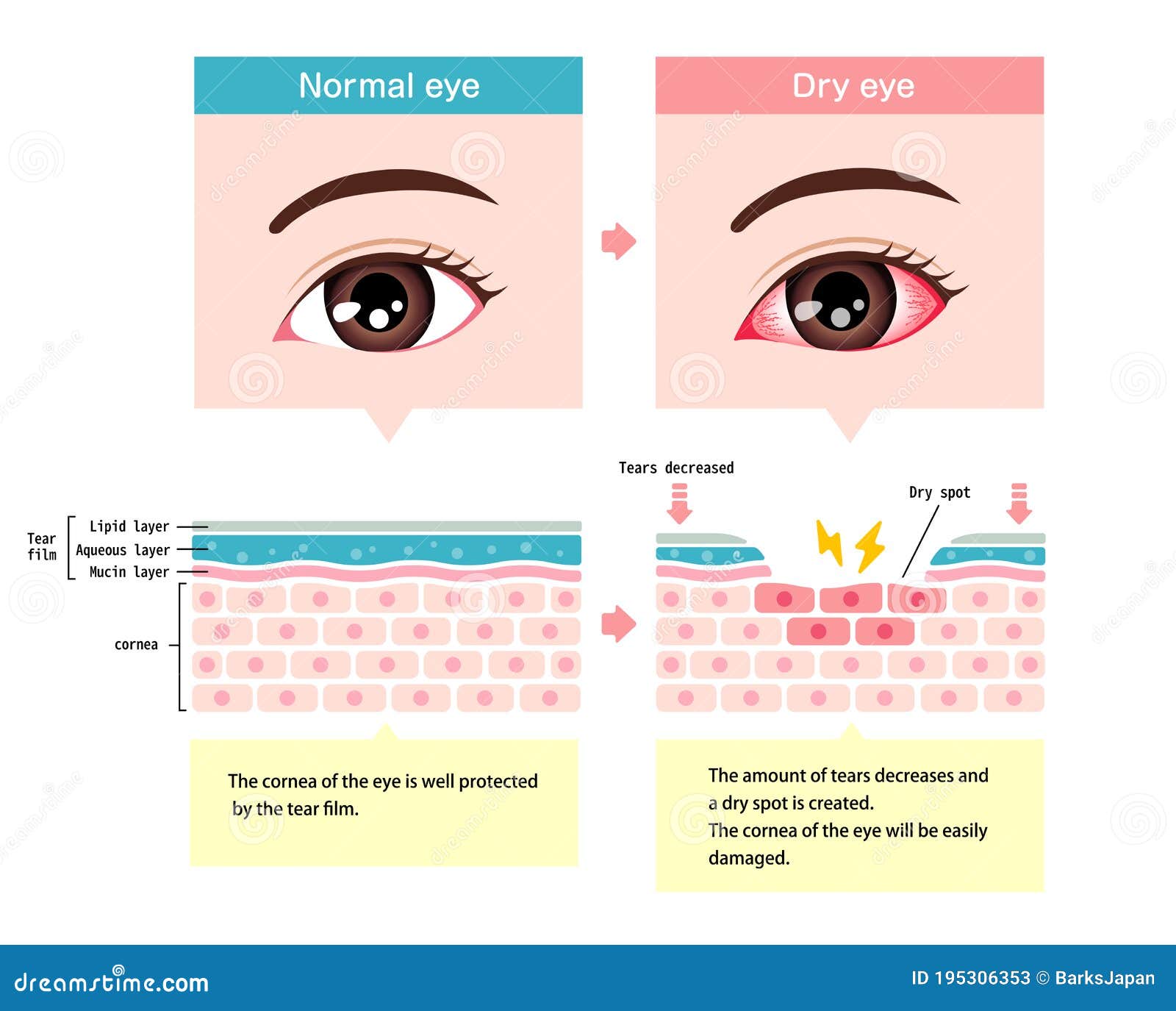 Comparison Illustration between Normal and Dry Eye. Cross Section of ...