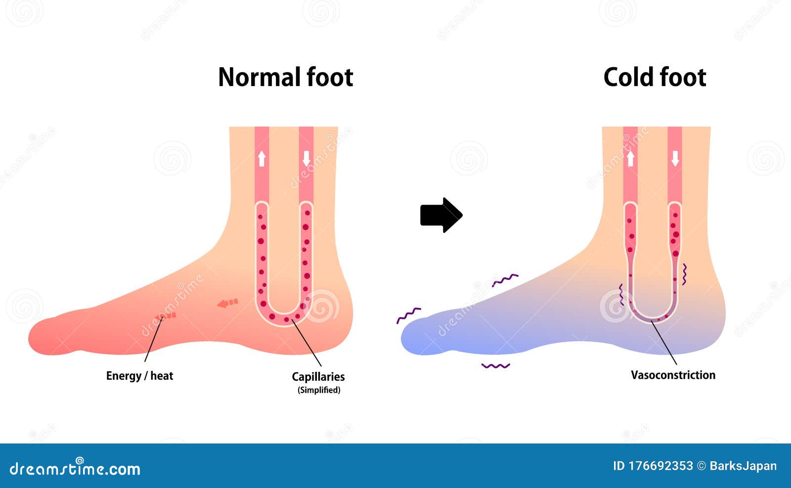 Normal Foot And Hallux Varus Vector Illustration | CartoonDealer.com ...