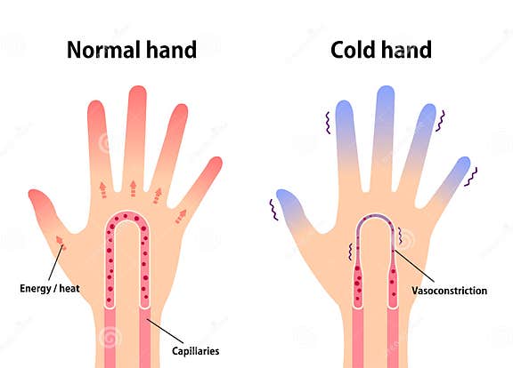 Comparison Illustration of Normal Hand and Cold Hand Sensitivity To ...