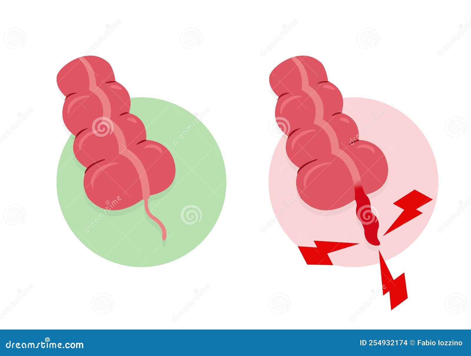 Comparison between an Inflamed Appendix and a Normal Appendix without ...