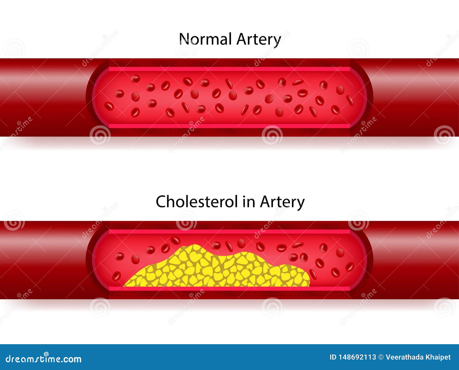 Comparison between Normal Artery and Cholesterol Stock Vector ...