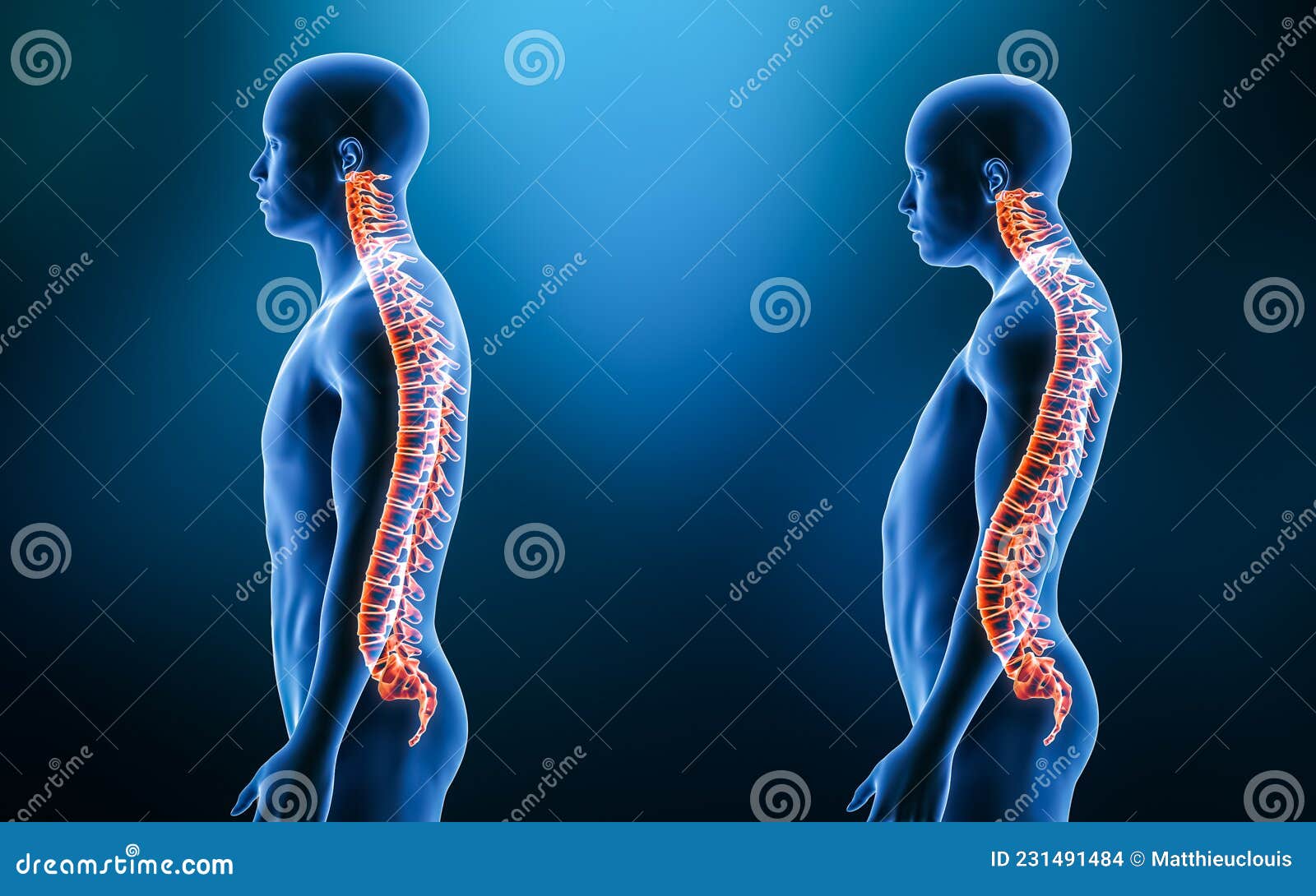 Comparison between Normal Backbone and Lordosis Curvature of the Spine ...