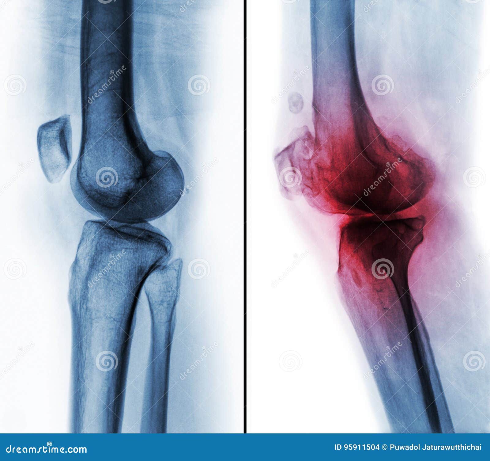 Comparison between Normal Human Knee & X28; Left Image & X29; and ...