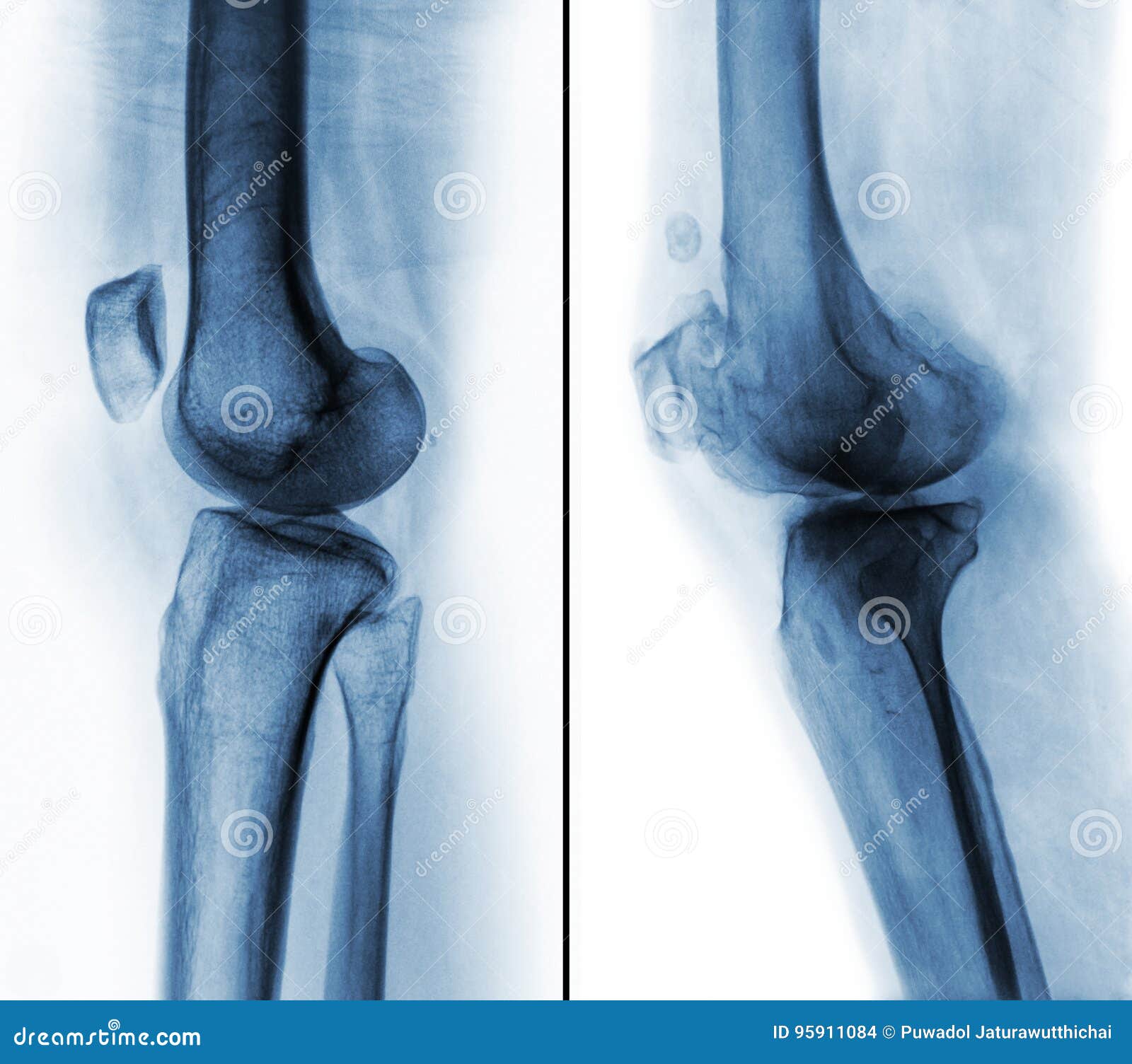 Comparison Between Normal Human Knee & X28; Left Image & X29; And ...