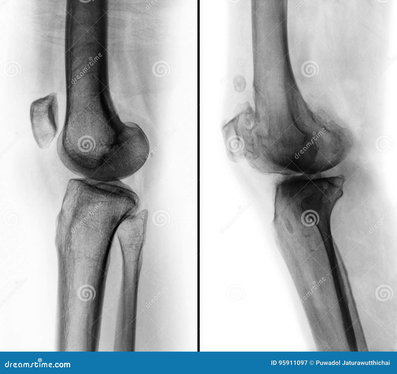 Comparison Between Normal Human Knee & X28; Left Image & X29; And ...