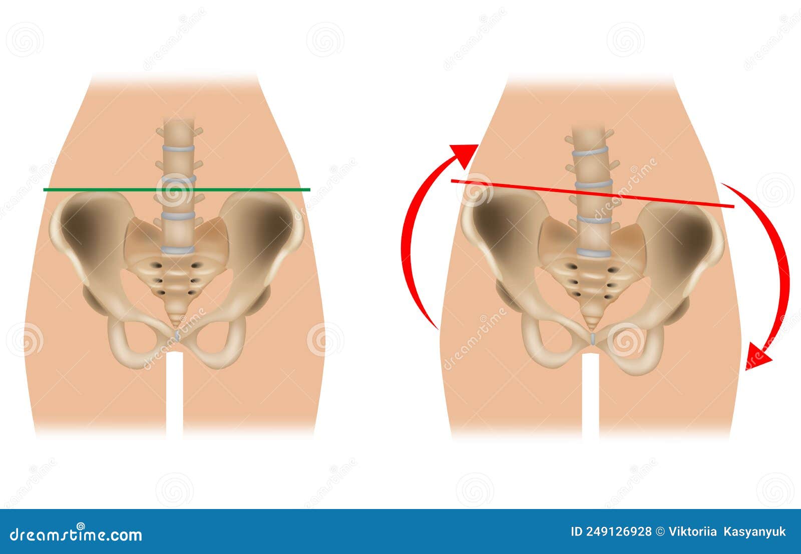 Comparison Of Pelvic Distortion Normal Pelvis And Distorted Pelvis Twisted Pelvis Or Pelvic