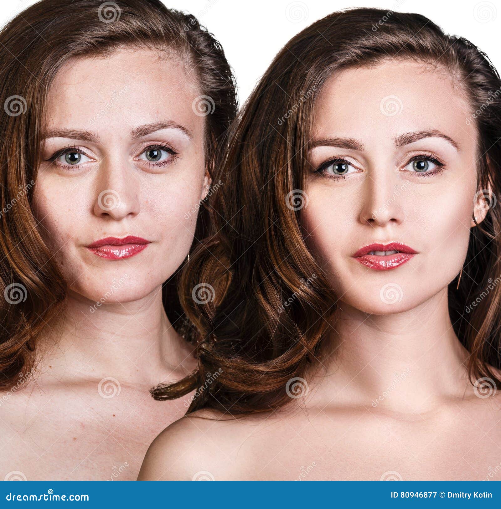 Comparison Portrait Of Teenage Girl With Problematic Skin, Before And ...