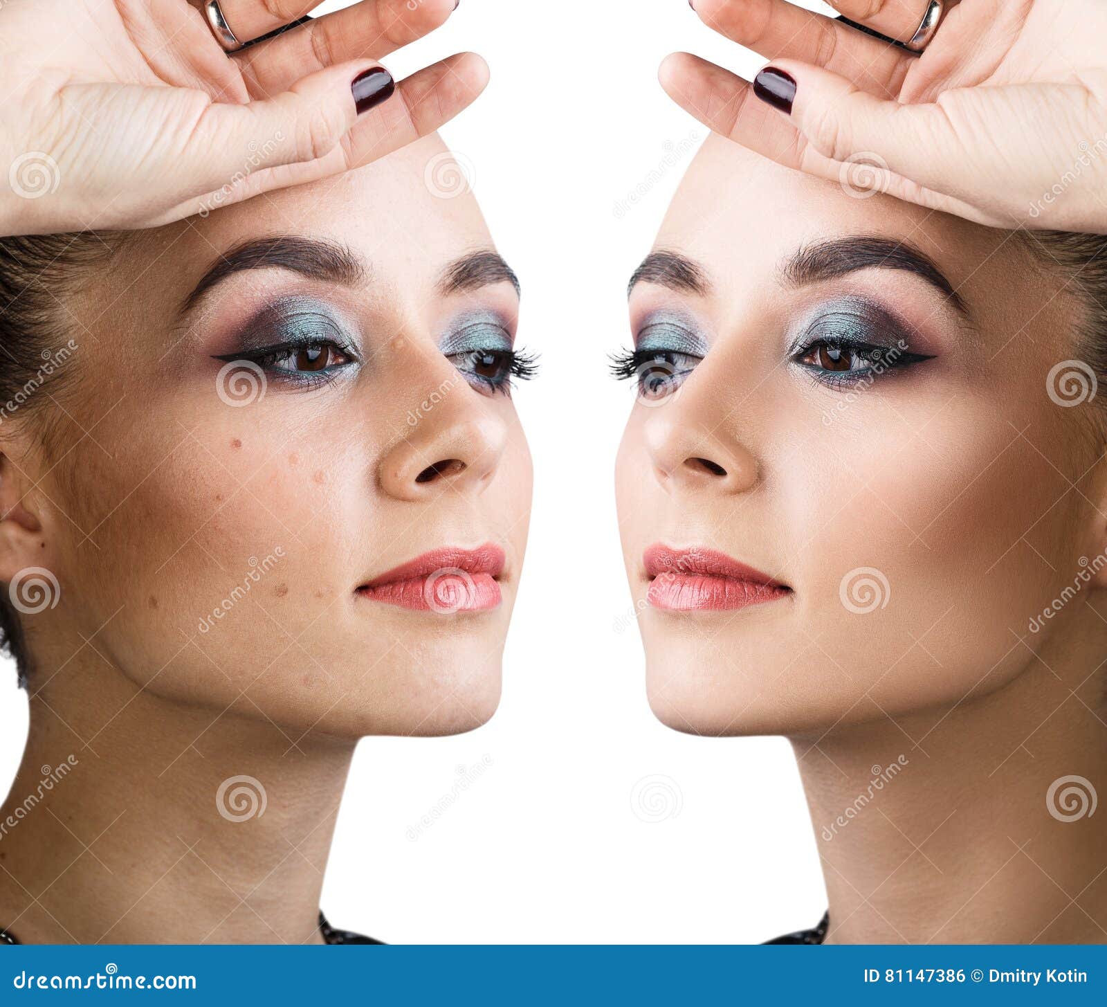 Comparison Portrait Of Teenage Girl With Problematic Skin, Before And ...
