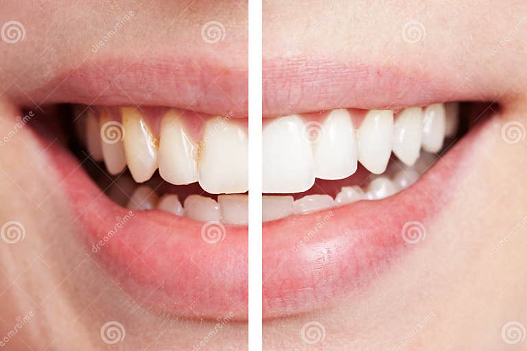 Comparison of teeth before stock image. Image of provision - 19443813