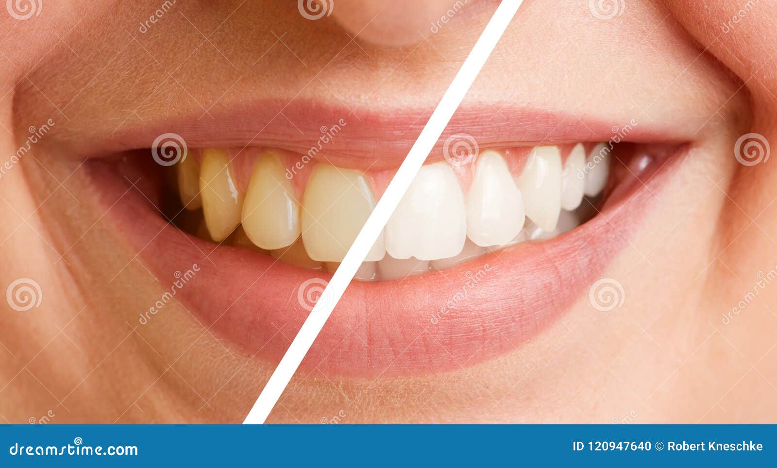 Comparison of Teeth before and after Tooth Cleaning Stock Photo - Image ...