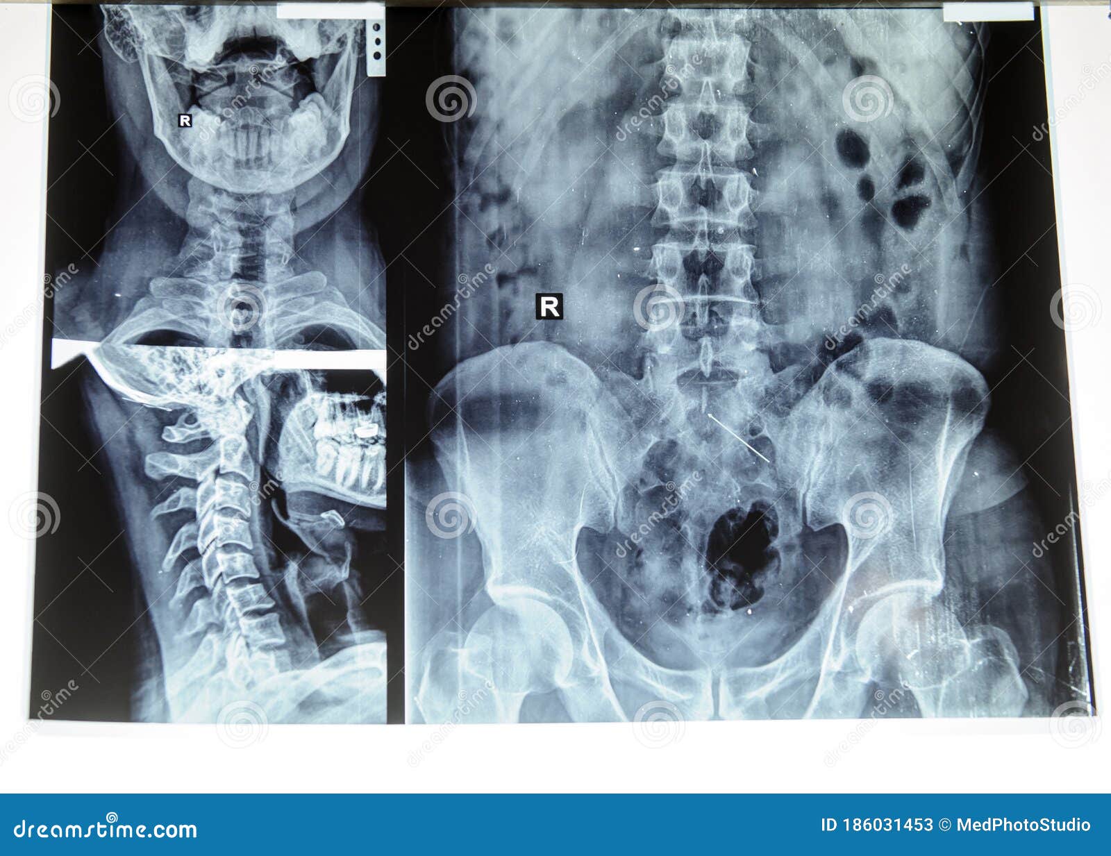 Complex X-ray with Cervical and Lombar Spine Stock Image - Image of ...