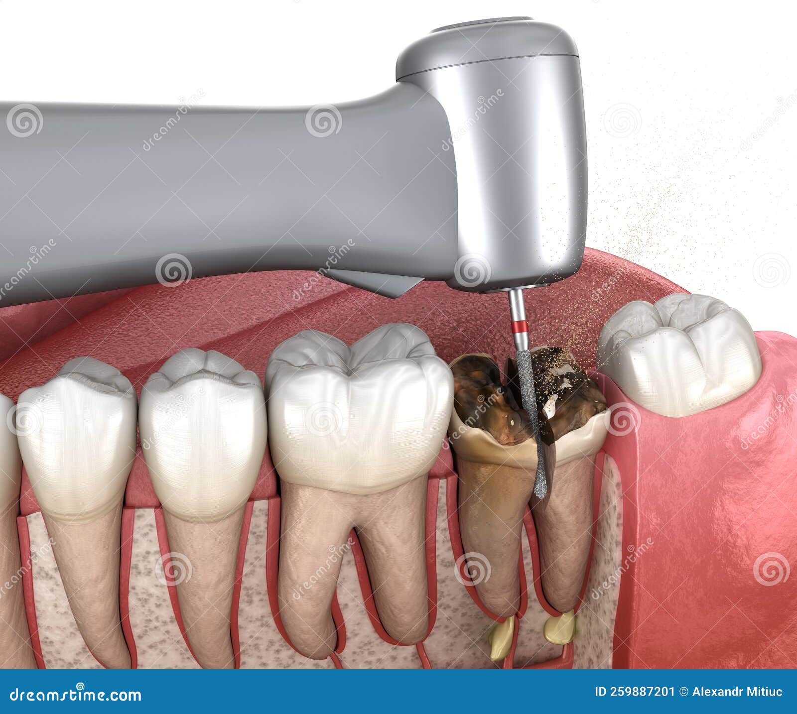Complex Tooth Extraction. Medically Accurate 3D Illustration of Dental ...