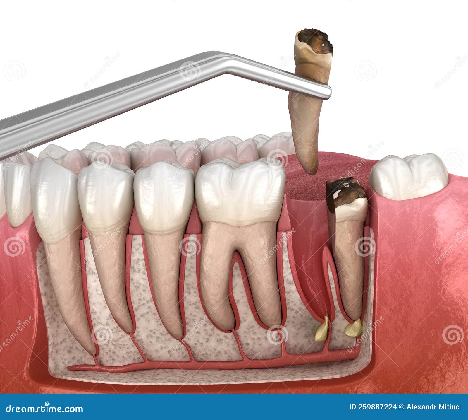 Complex Tooth Extraction. Medically Accurate 3D Illustration of Dental ...