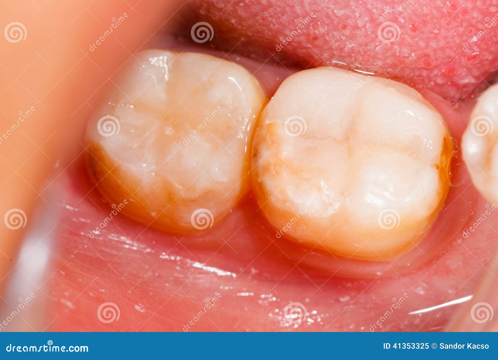 Composite Filling Material stock image. Image of care - 41353325