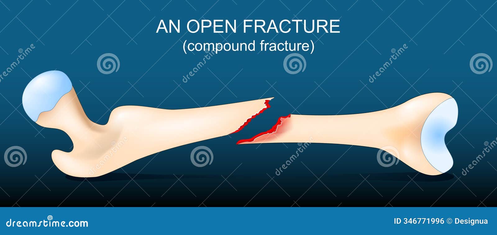 Impacted Fracture Bone. Infographics. Vector Illustration On A Lined ...
