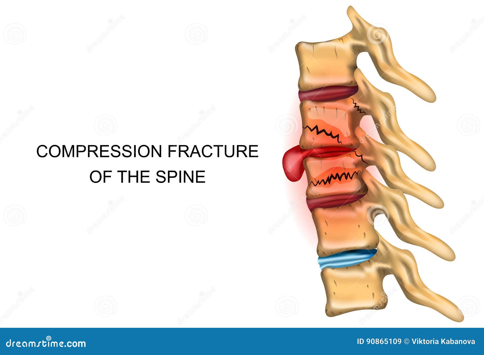 Compression Fracture of the Spine Stock Vector - Illustration of ... Compression Fracture of the Spine Stock Vector - Illustration of ...