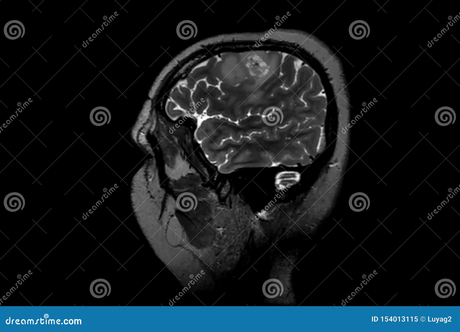 Computed Resonance Imaging of the Human Brain. Stock Image - Image of ...