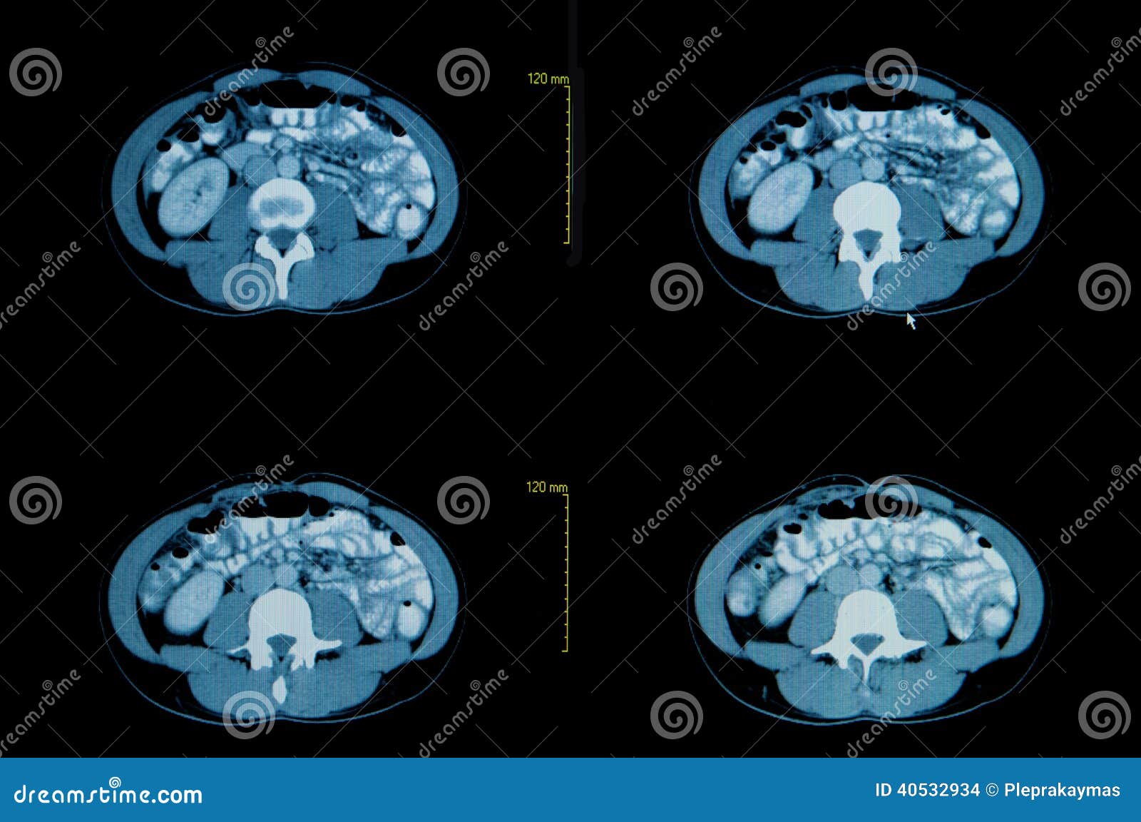 Computed Tomogram Of Bone Fracture Stock Photo | CartoonDealer.com ...