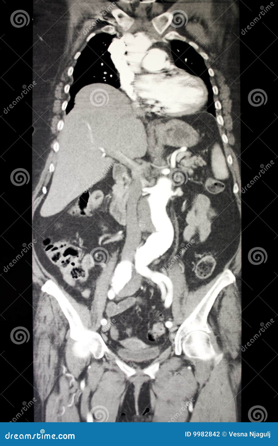 Computed Tomography of Body (CT) Stock Photo - Image of spleen, body ...