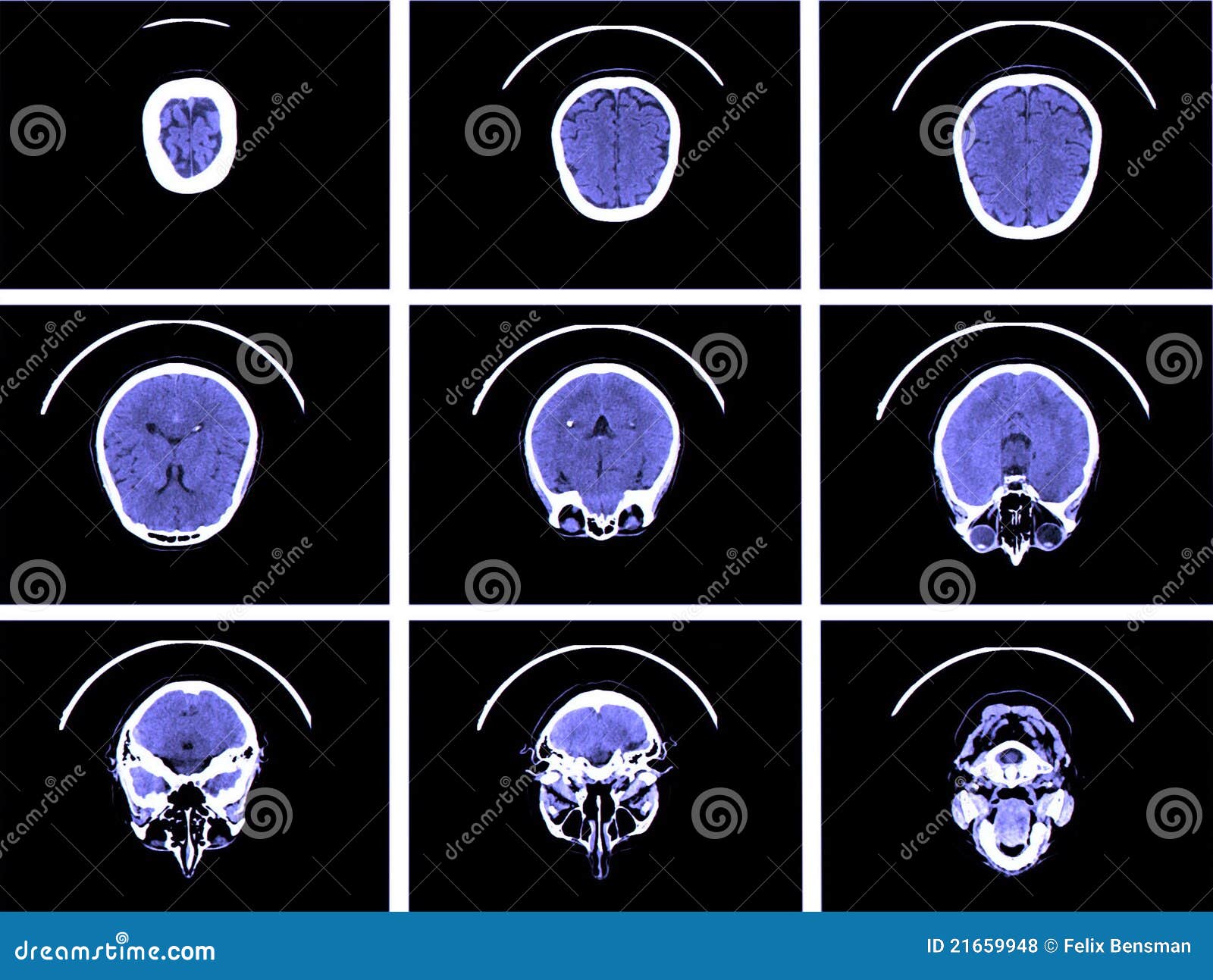 Computed Tomography of Brain Stock Photo - Image of grey, xray: 21659948