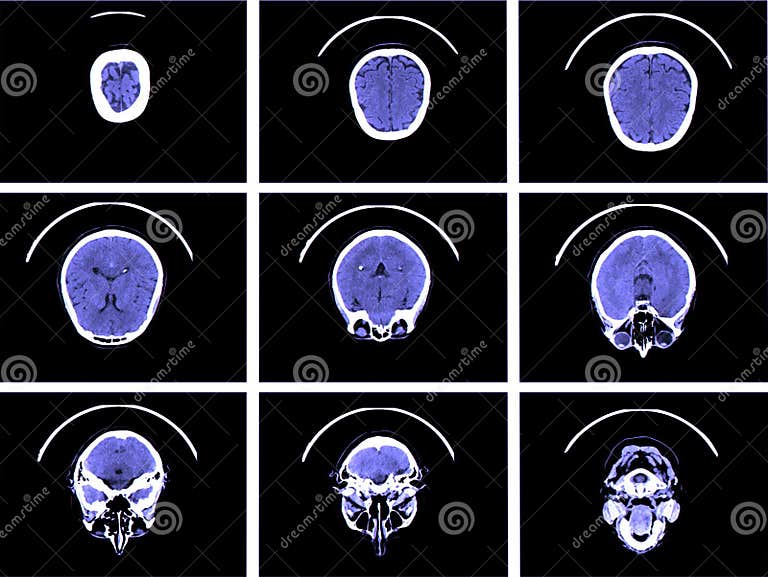 Computed Tomography of Brain Stock Photo - Image of grey, xray: 21659948