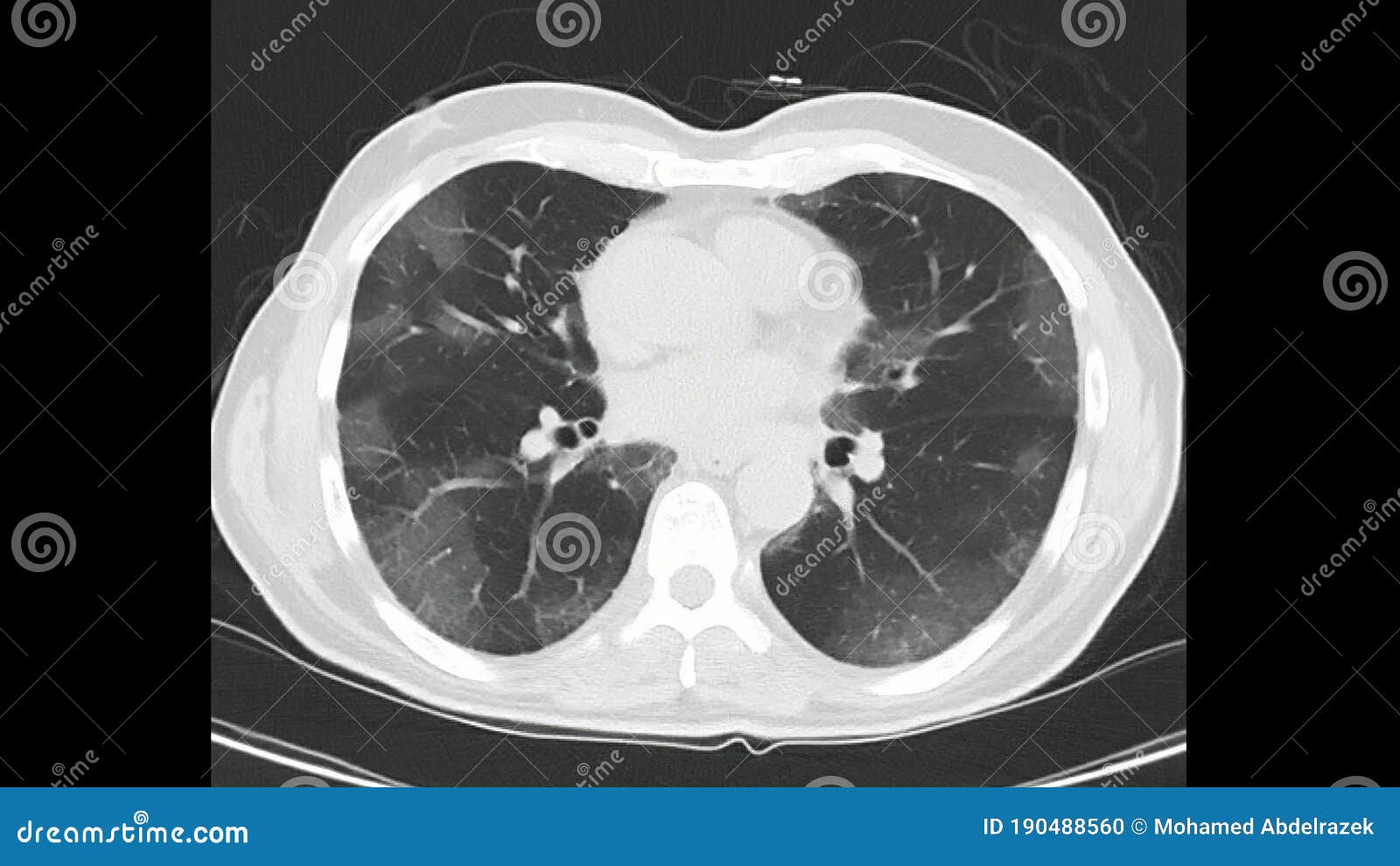 Computed Tomography of the Chest High Resolution CT Chest in a ...