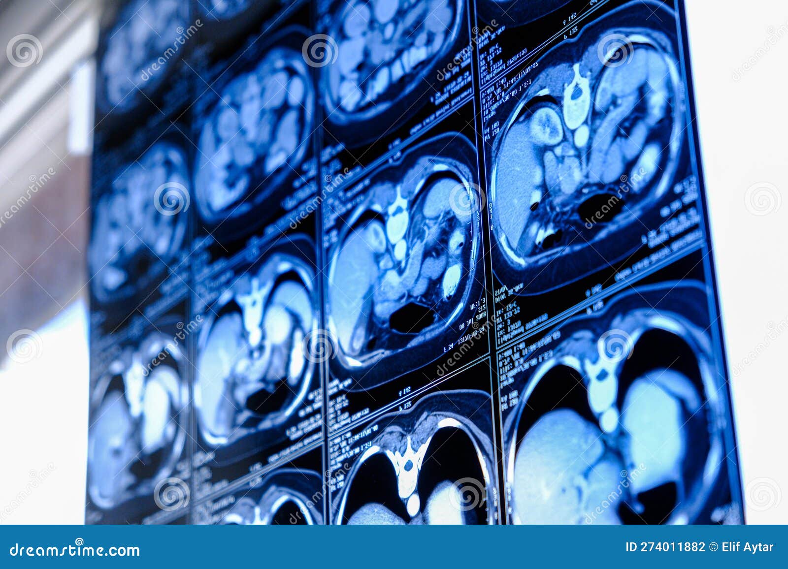 Computed Tomography (CT Scan) of Chest with Abdomen Stock Photo - Image ...
