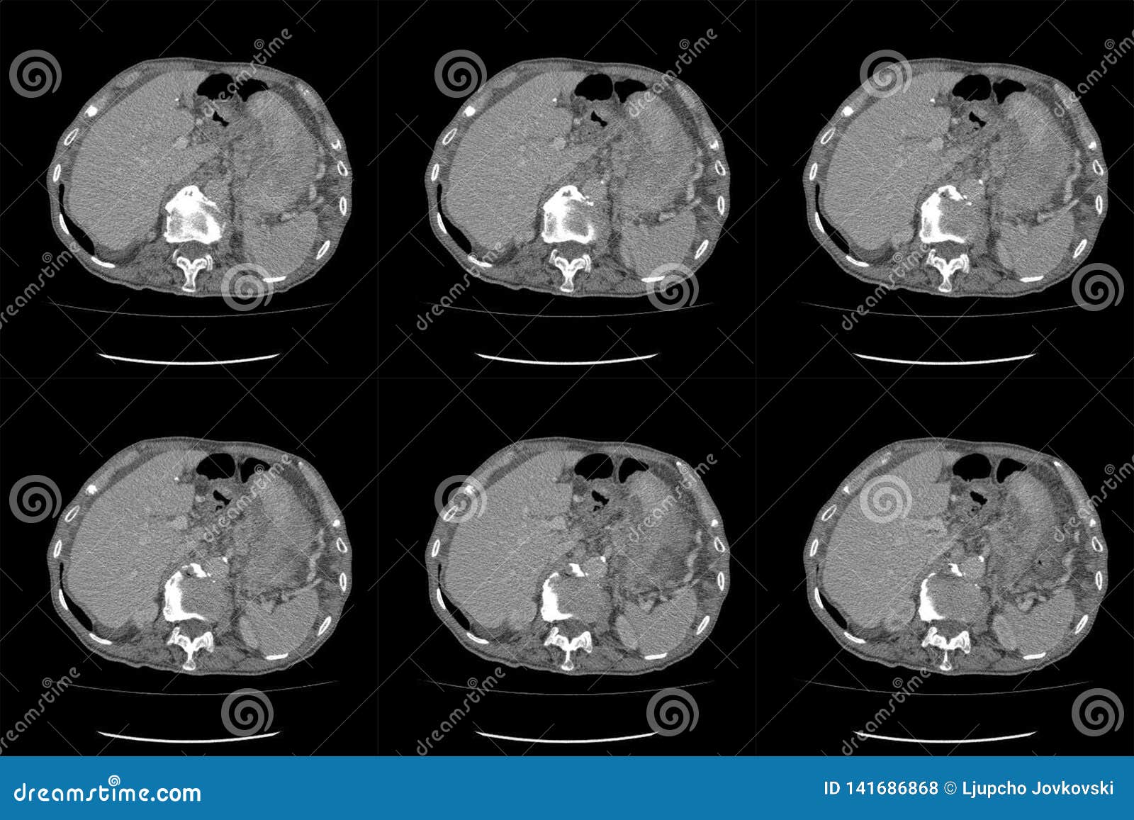Computed Tomography CT Whole Abdomen in Axial. Part Eleven Stock Photo ... Computed Tomography CT Whole Abdomen in Axial. Part Eleven Stock Photo ...