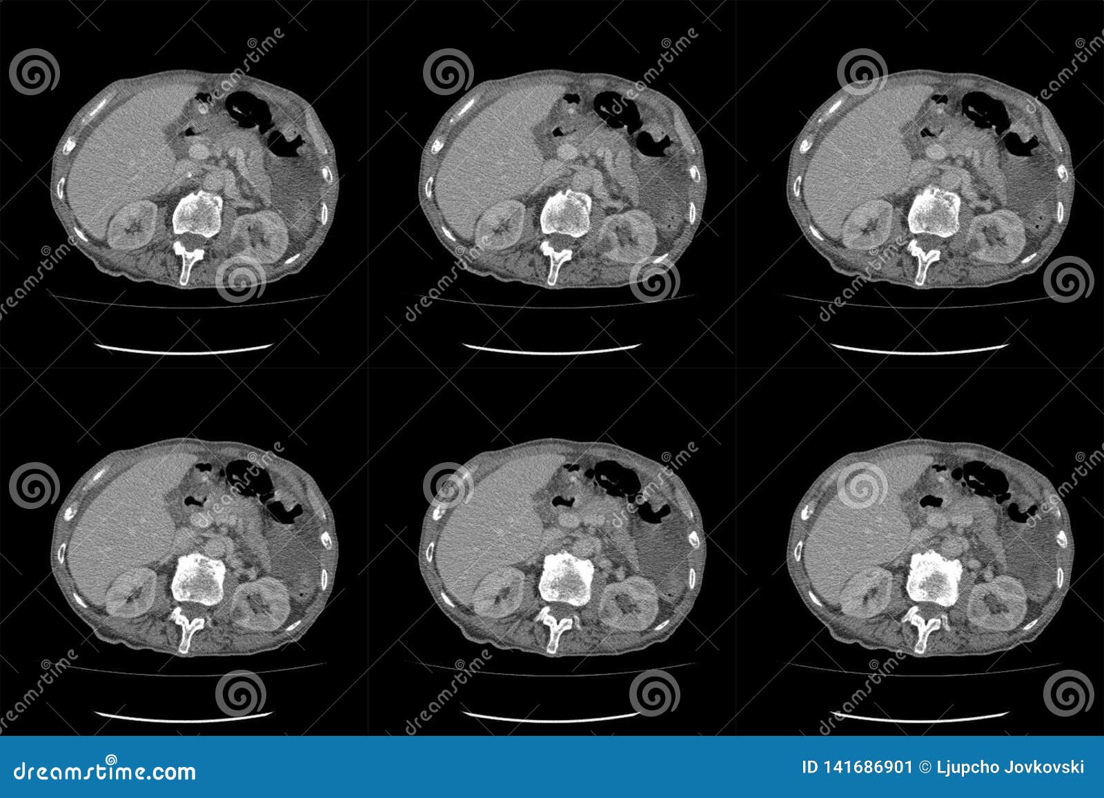 Computed Tomography Ct Whole Abdomen In Axial Part Seventeen Stock