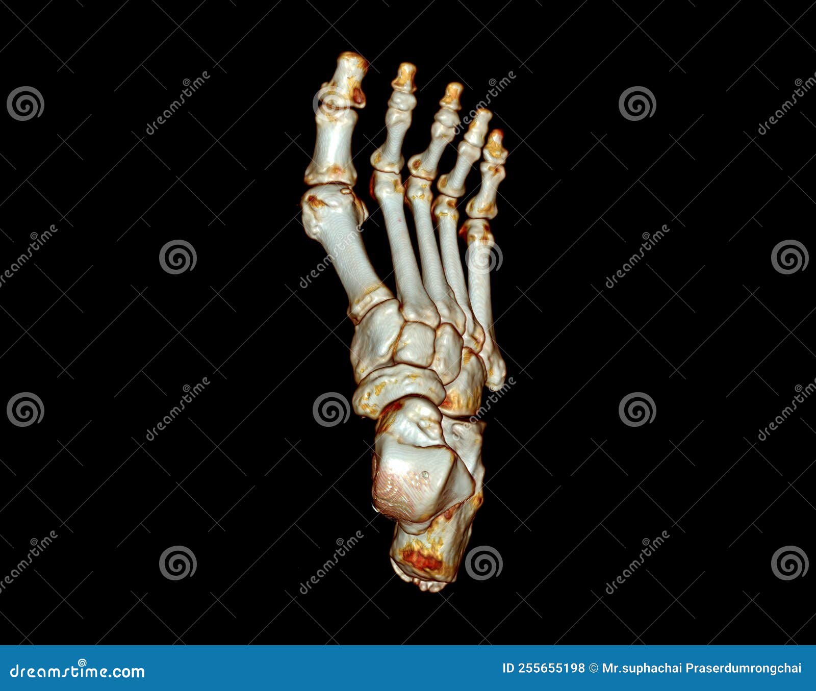 Computed Tomography of the Foot Stock Illustration - Illustration of ...