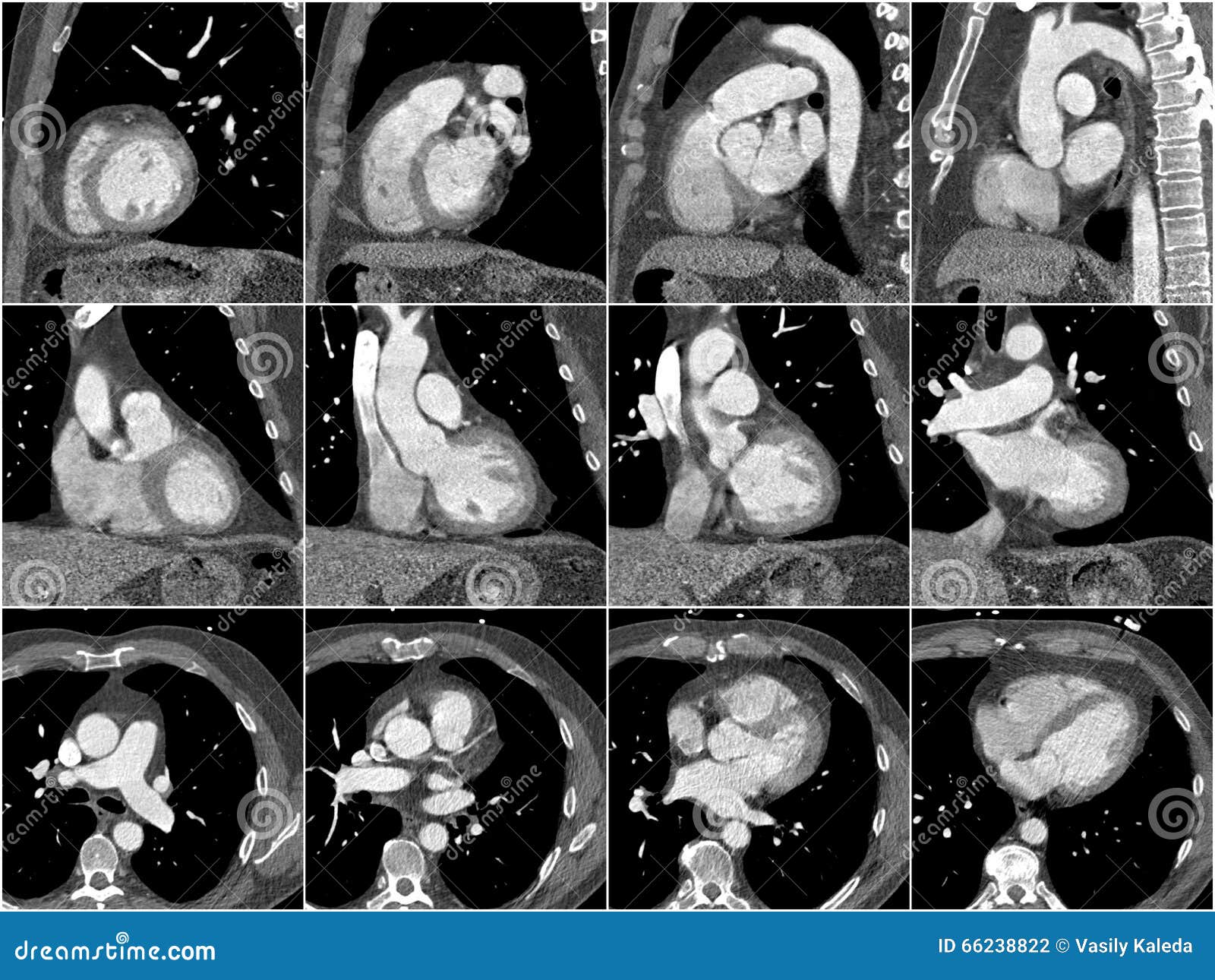 Computed Tomography of the Heart Stock Photo - Image of chamber ...