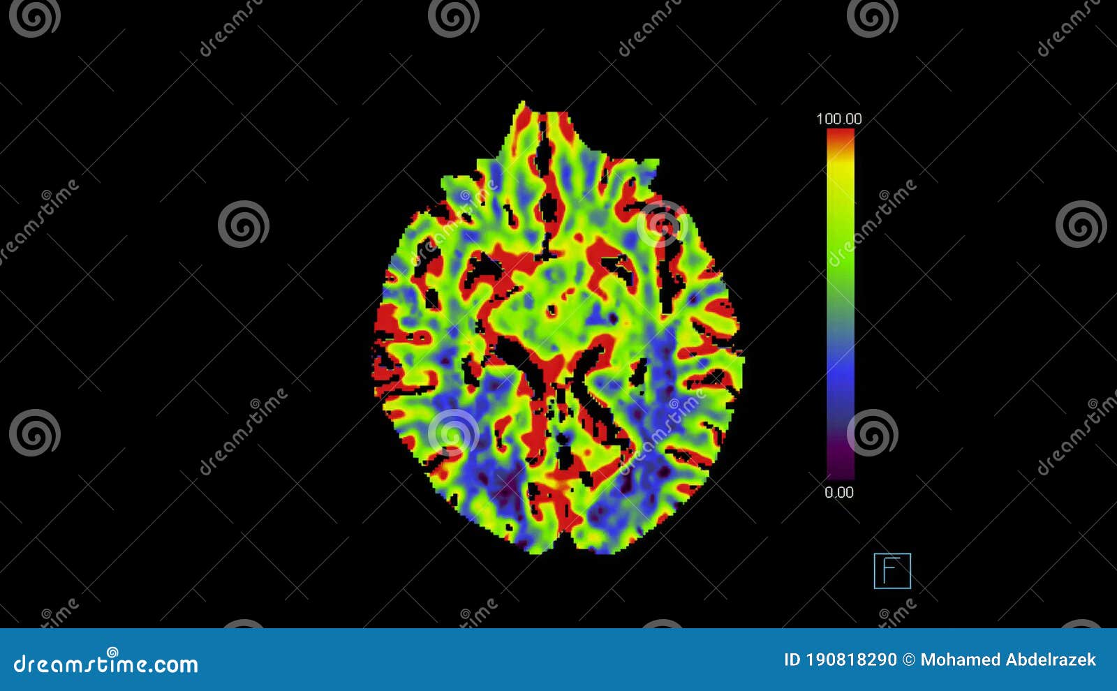 Computed Tomography of the Human Brain Perfusion Study Stock Footage ...