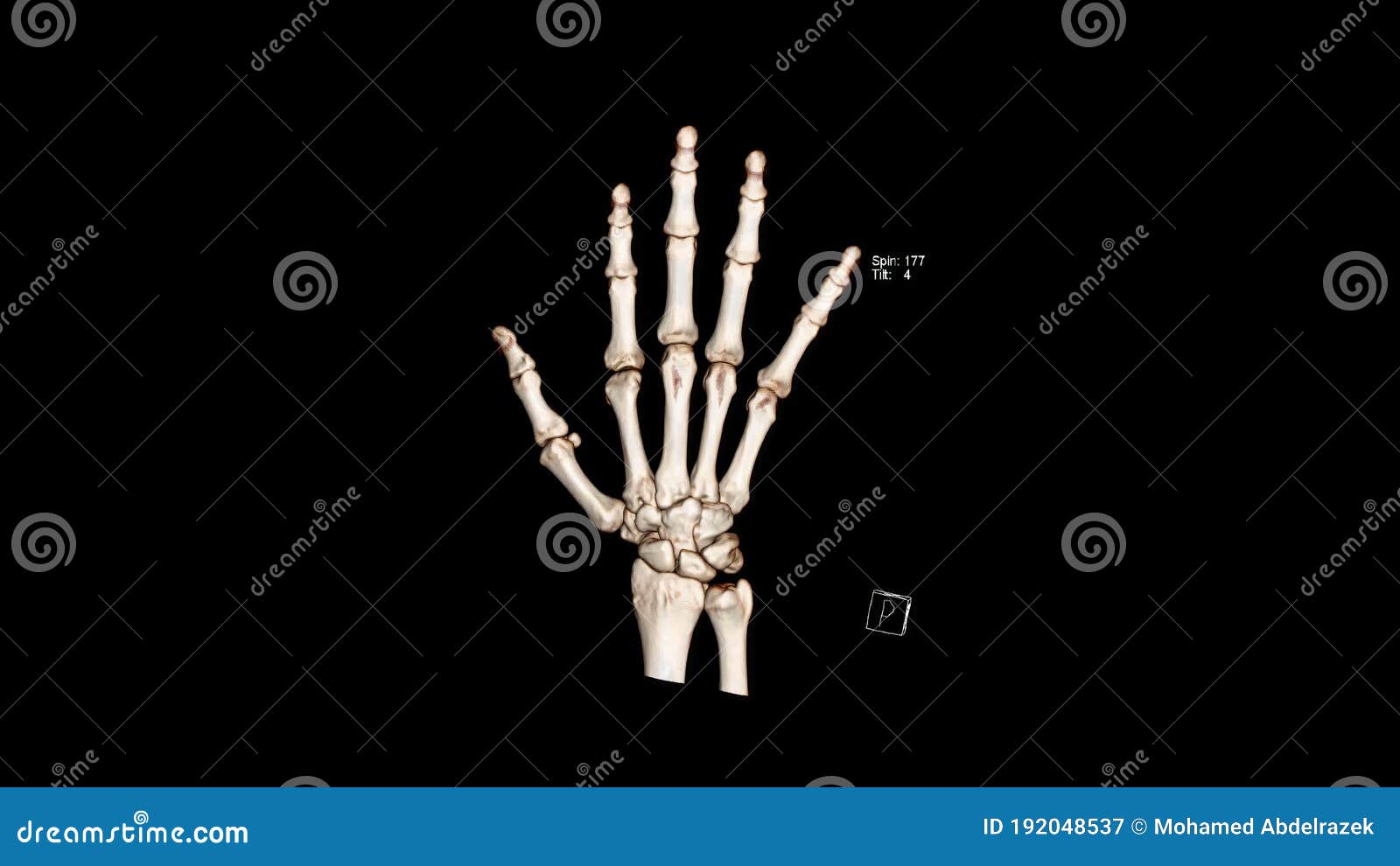 Computed Tomography Volume Rendering Examination of the Hand Showing ...